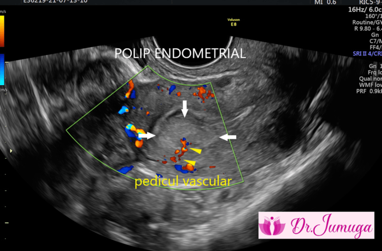 Polip Endometrial - Dr. Jumuga - Echipă de excelență în sănătatea femeii