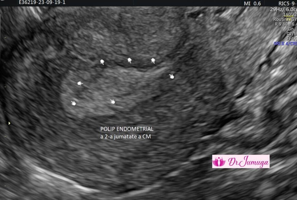 Polip Endometrial - Dr. Jumuga - Echipă de excelență în sănătatea femeii