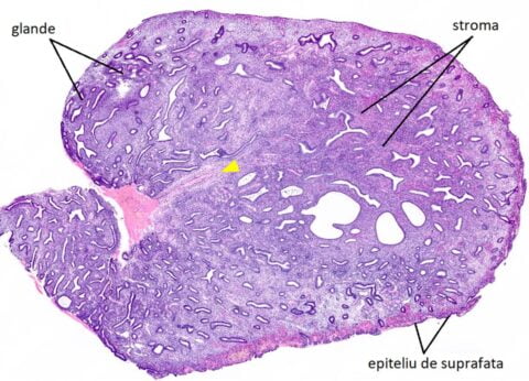 Polip Endometrial - Dr. Jumuga - Echipă de excelență în sănătatea femeii
